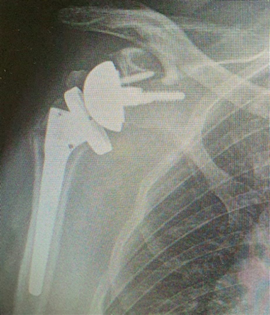 Golfing Injuries | Shattered Shoulder | Humerus